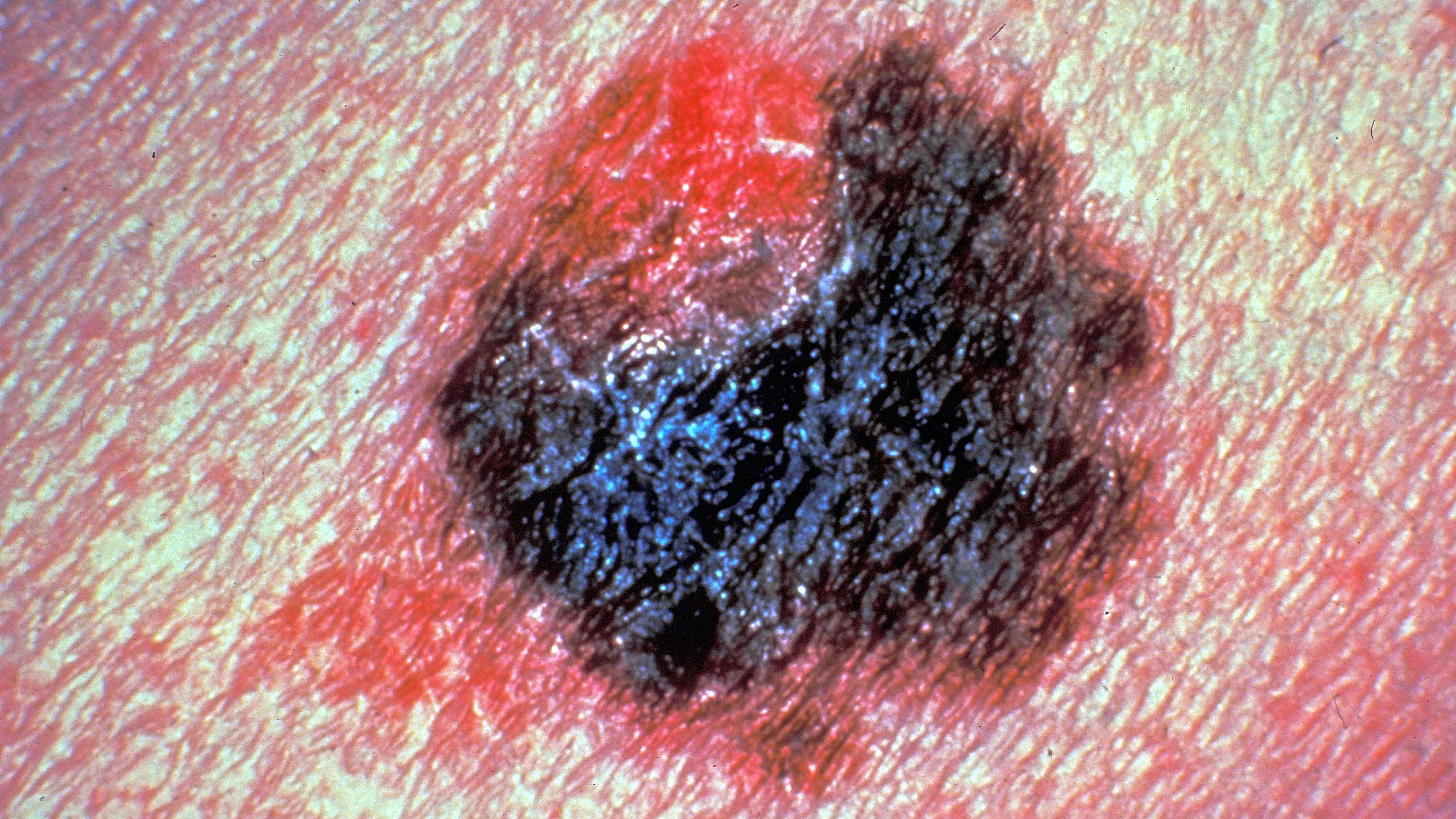 95% of Late-Stage Skin Cancer Patients Used to Die - Now More Than Half ...